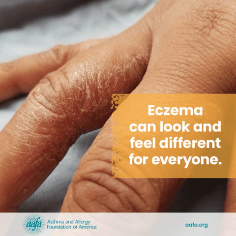 Eczema | AAFA.org
