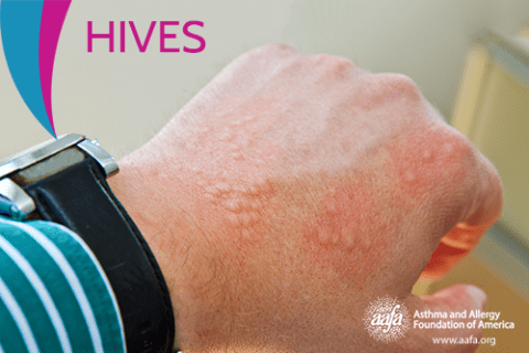 Hives (Urticaria) | AAFA.org